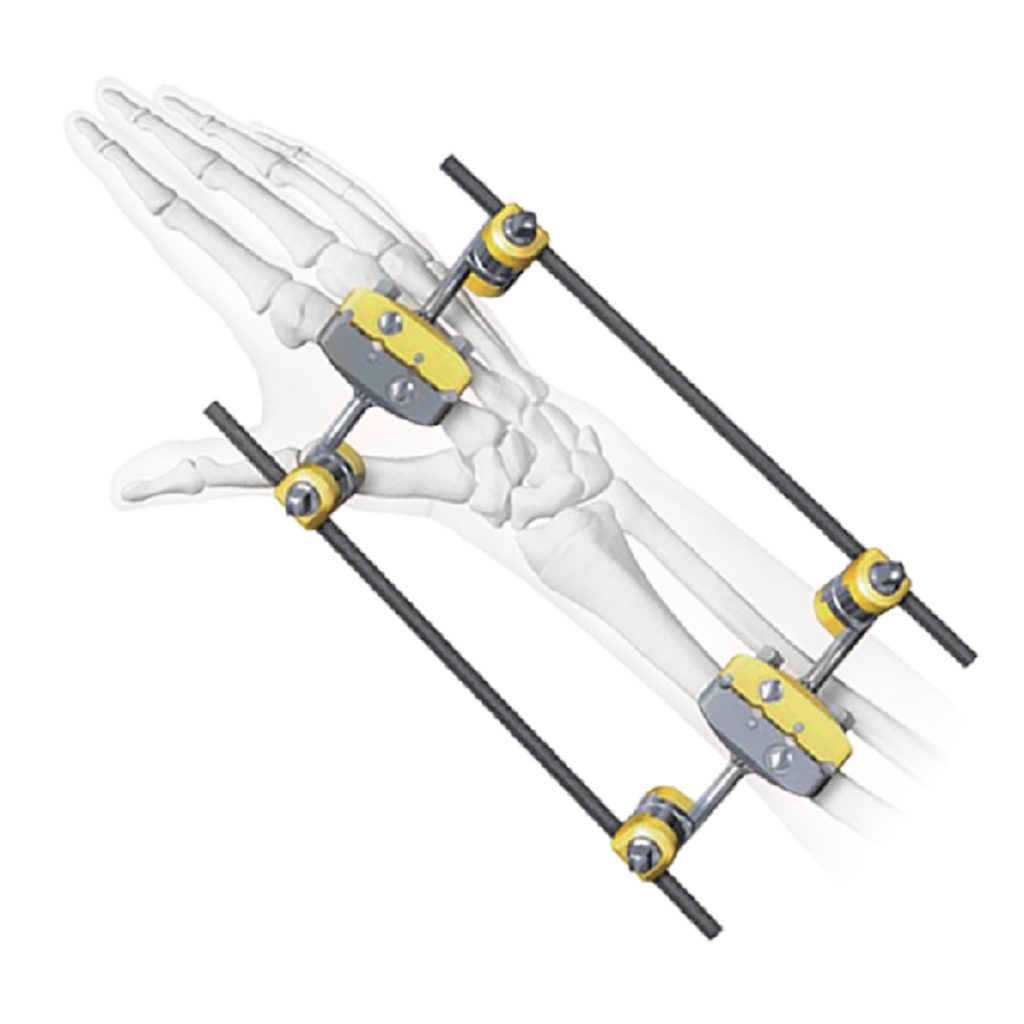 Fixation System Combinational - Medica Ortho